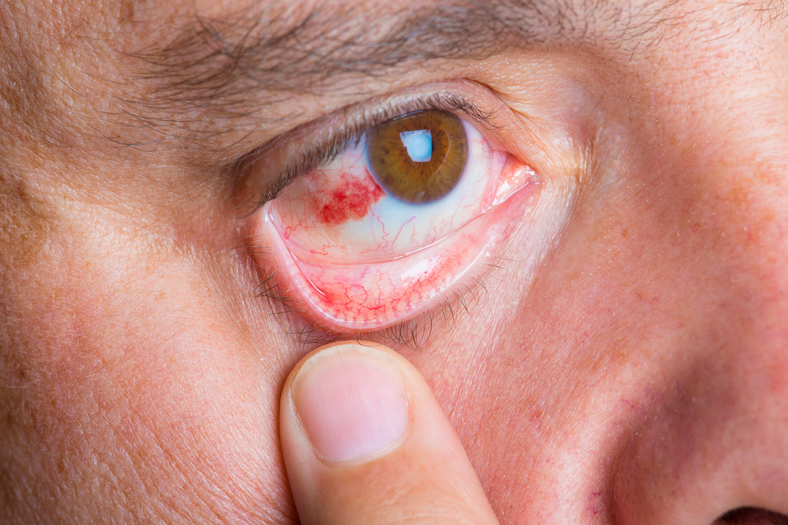 Episcleritis Vs Scleritis Scleritis Unveiled: London's Top Eye Clinic