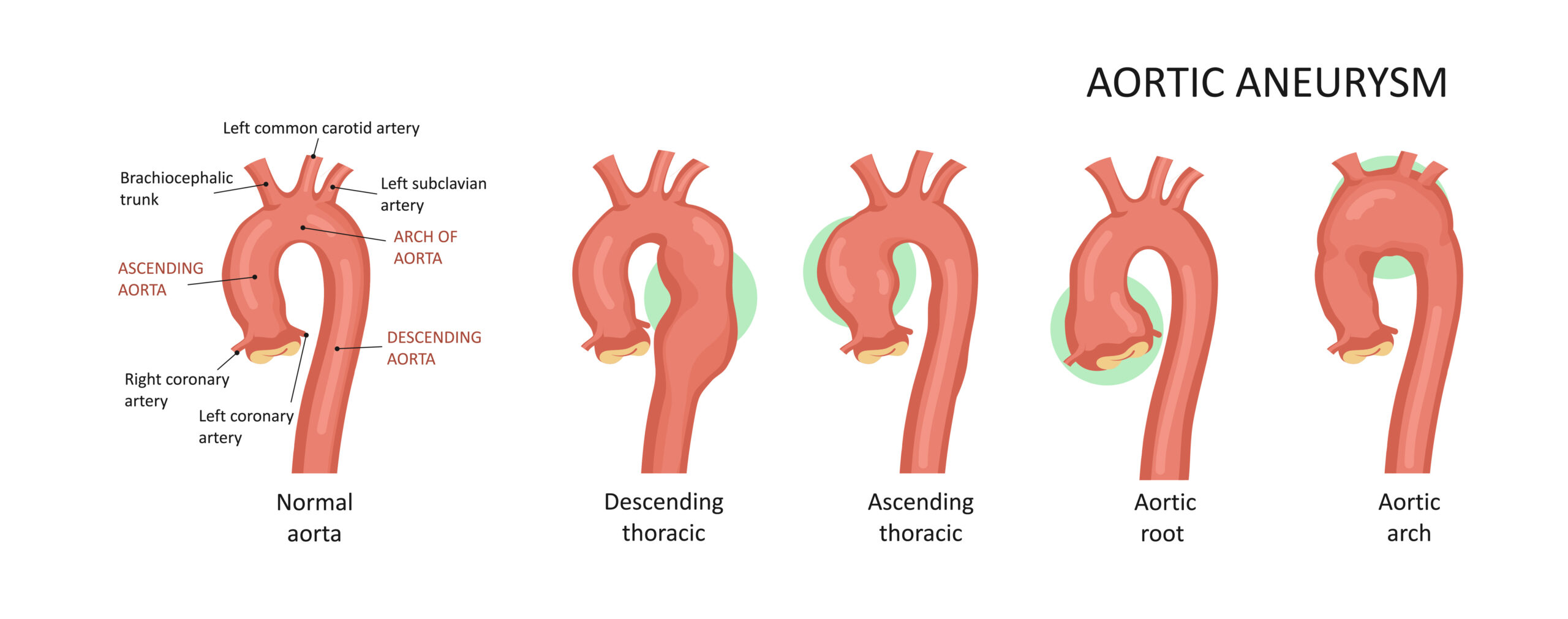 Aortic Root Enlargement The DADA2 Foundation