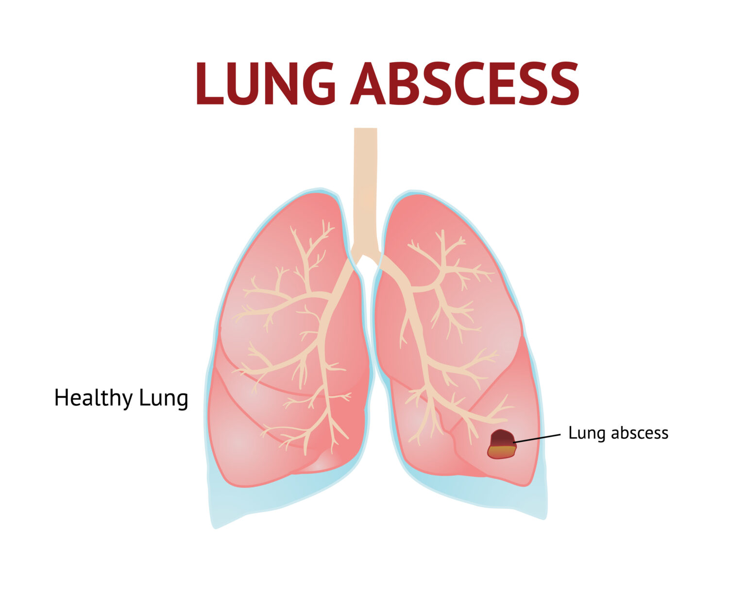 Lung Abscess The Dada2 Foundation