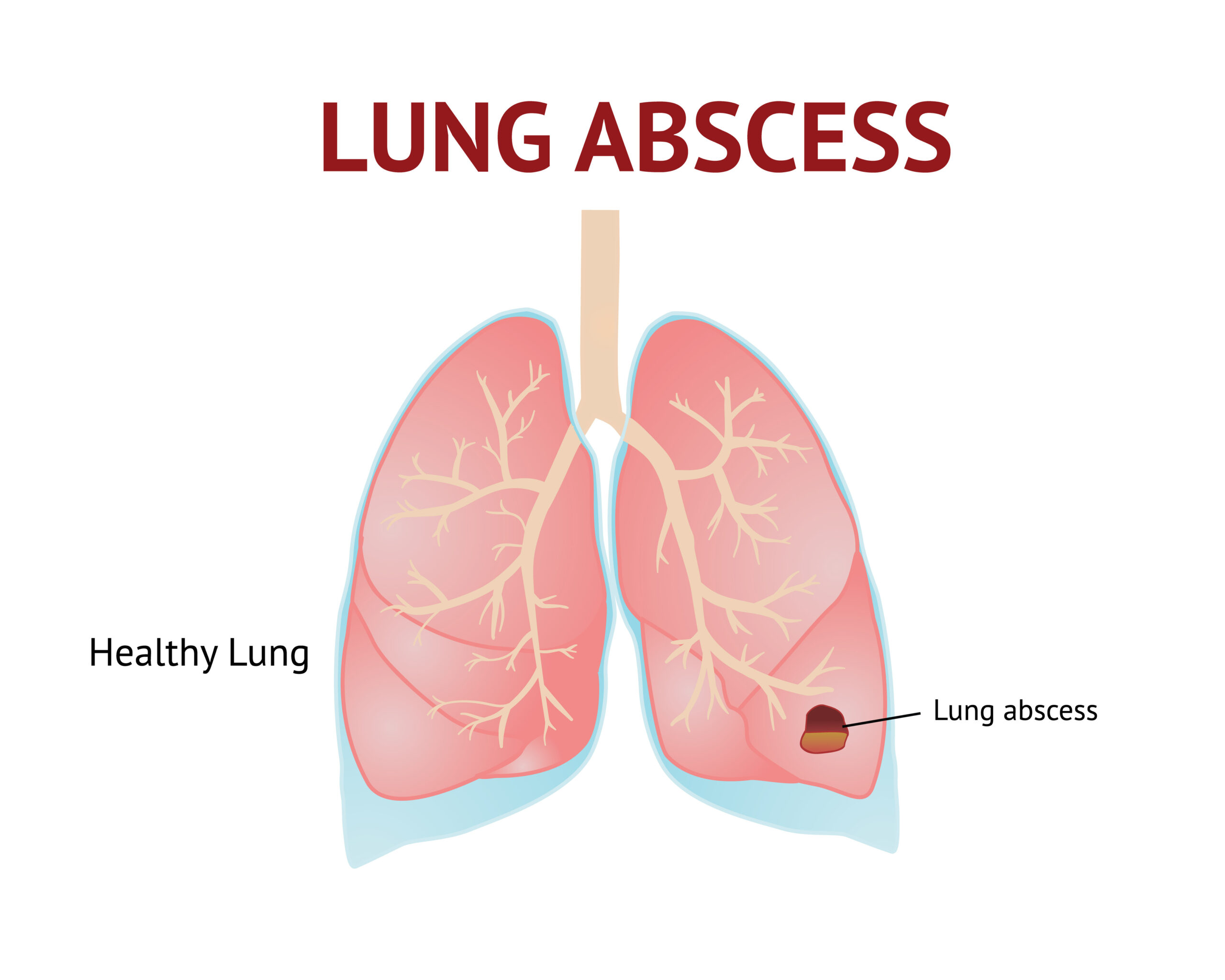 Lung Abscess | The DADA2 Foundation