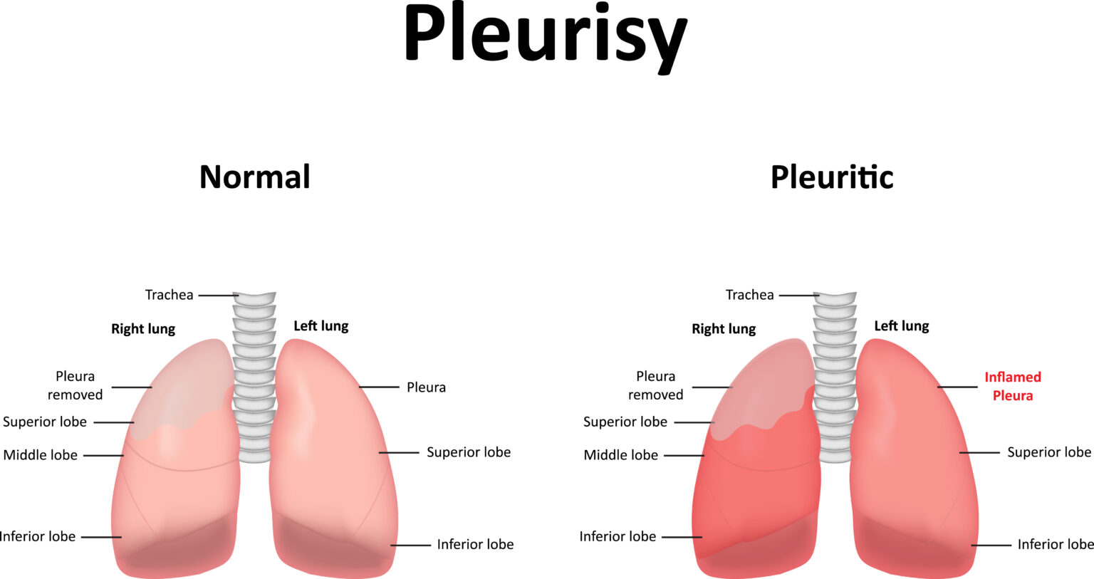 Pleuritis | The DADA2 Foundation