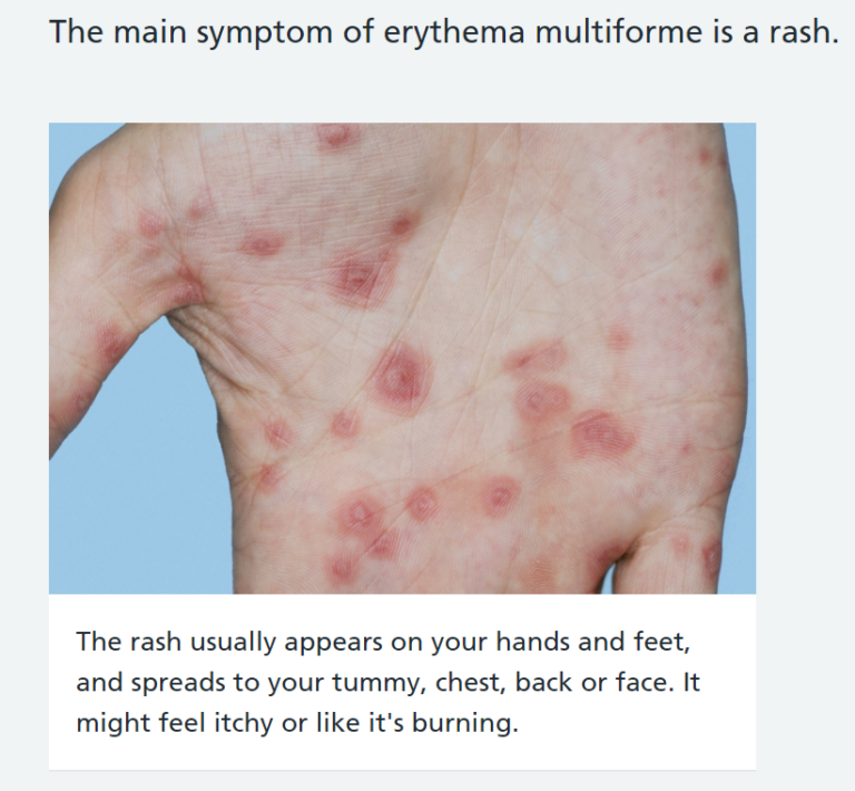 Erythema Multiforme-like Lesions | The DADA2 Foundation