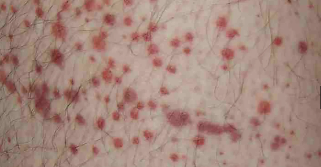 Purpura | The DADA2 Foundation