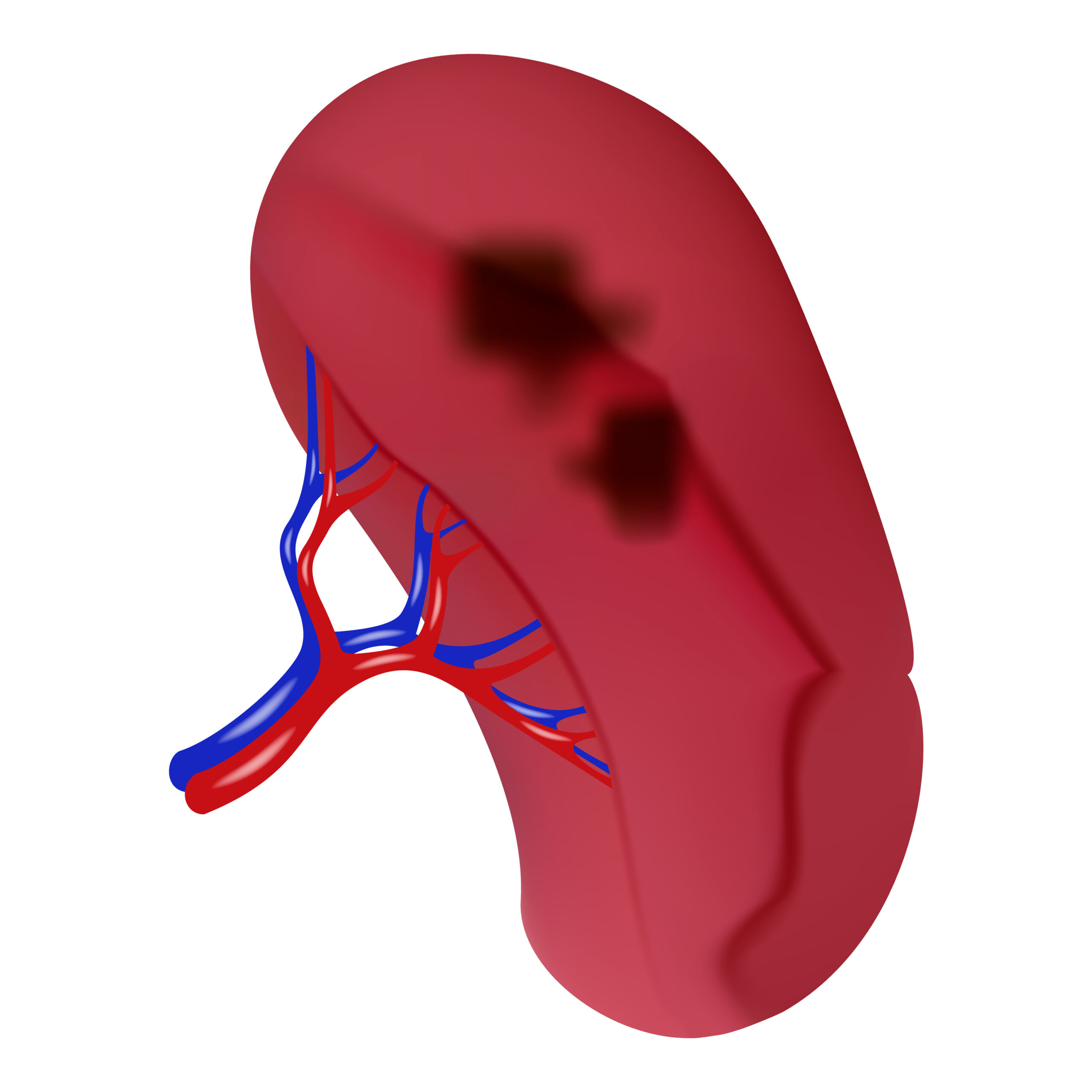 Splenic Infarction | The DADA2 Foundation